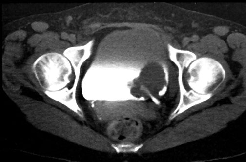Developments in the Management of Bladder Cancer | The British ...