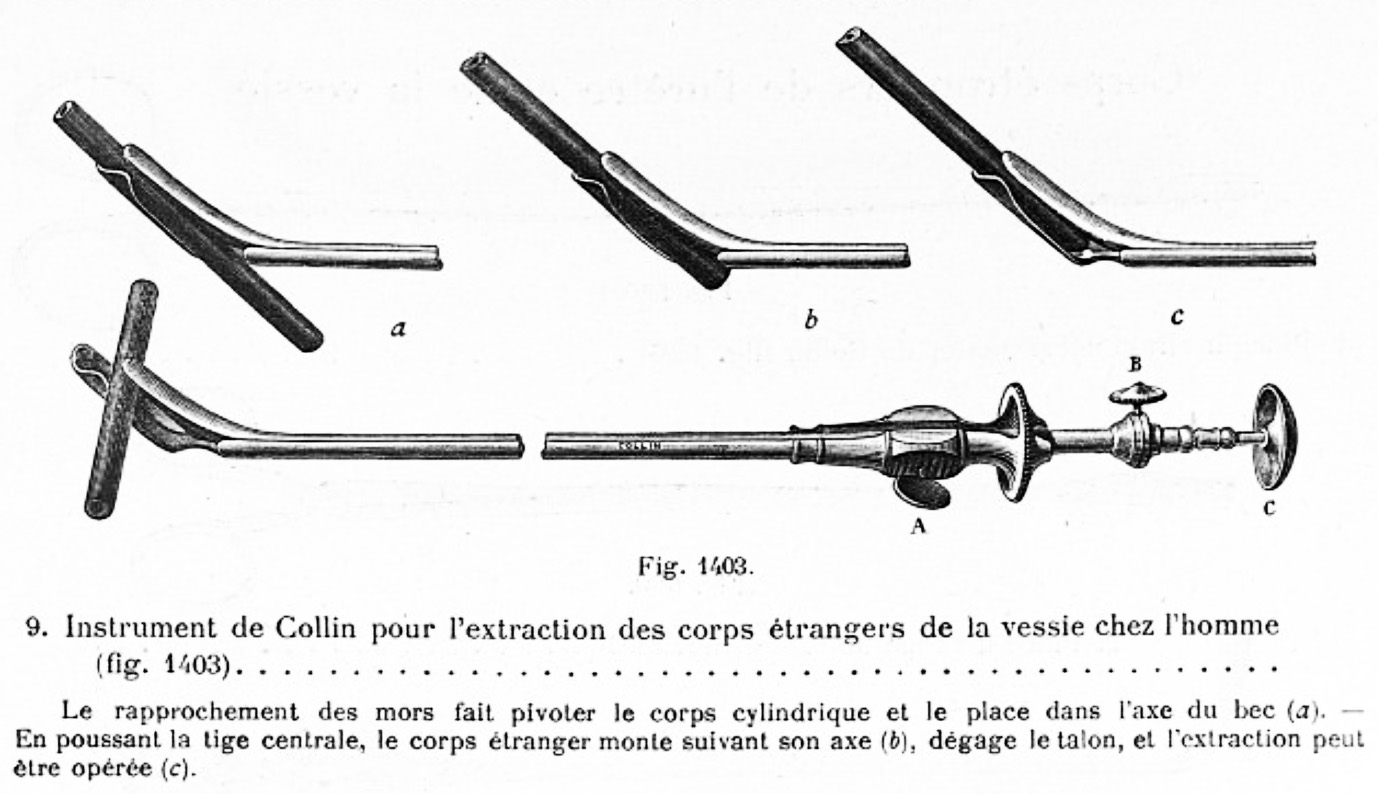 Removing Foreign Bodies | The British Association of Urological ...