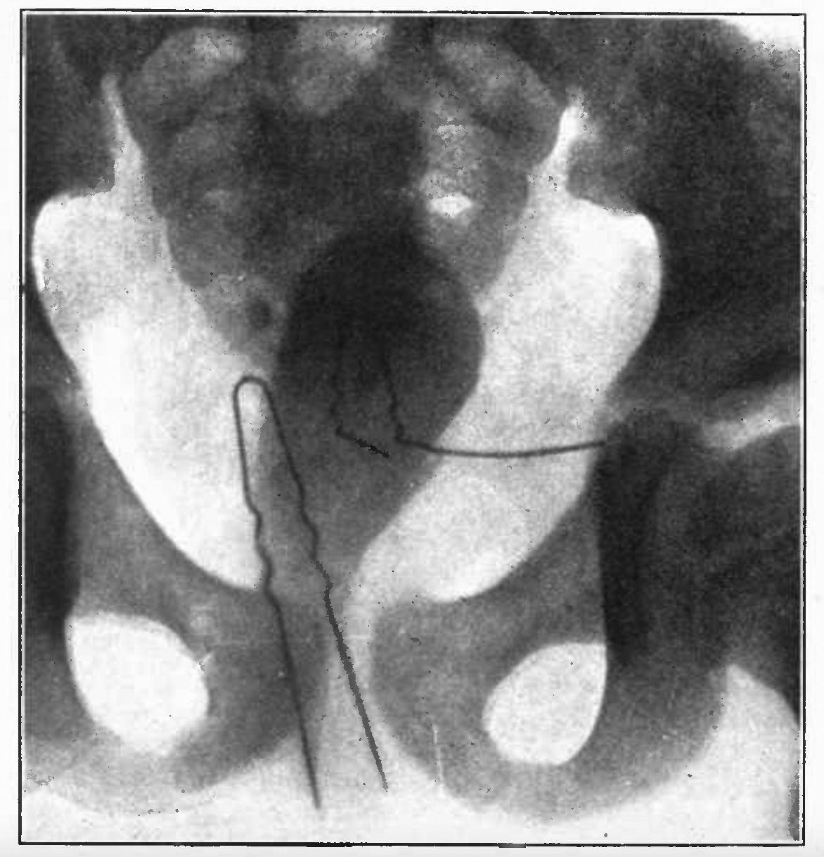 Removing Foreign Bodies | The British Association of Urological ...