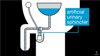 Insertion of an artificial urinary sphincter (AUS) in men | The British ...