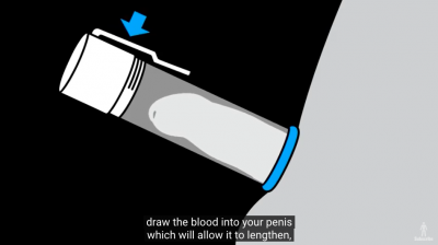 Vacuum erection assistance devices (VEDs) | The British Association of ...